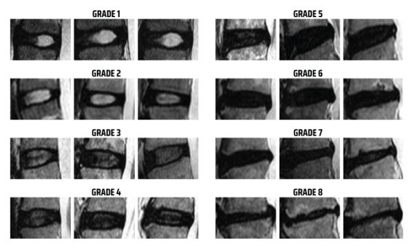 Disc Degeneration Via Disc Np